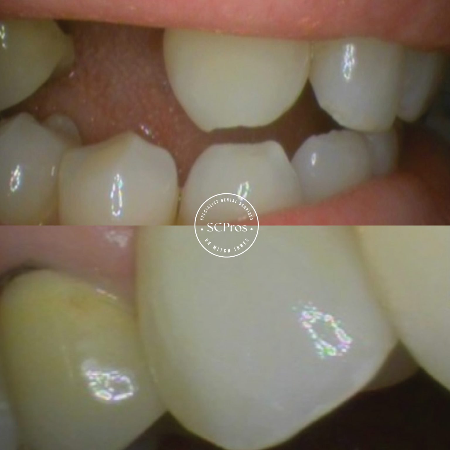 Smile Gallery – Sunshine Coast Prosthodontics
